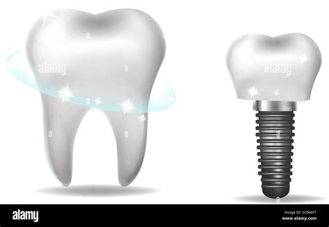 Dental Implants Prosthetics 3d Realistic Style Dentistry Healthy