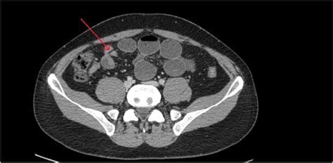 Ct Scan Of The Patients Abdomen Showing A Transition Point In The