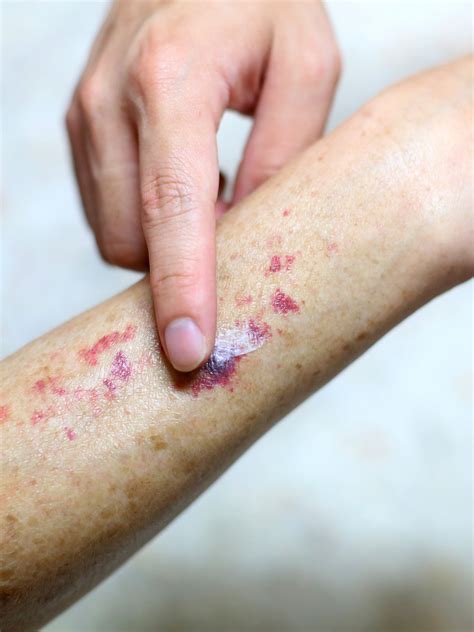 National Bleeding Disorders Foundation Formerly Nhf National Bleeding Disorders Foundation