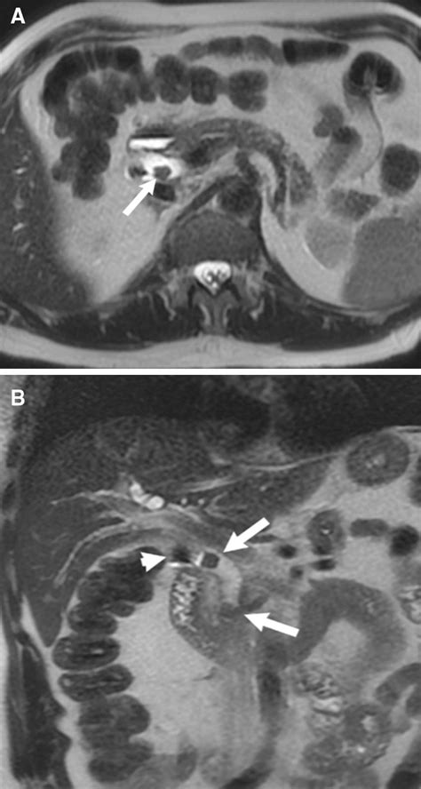 Choledocholithiasis A Axial And B Coronal T2w Mri Images Demonstrate