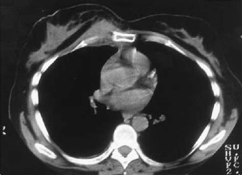 Figure 1 From Chest Wall Abscess After Ureteric Stent Insertion Semantic Scholar