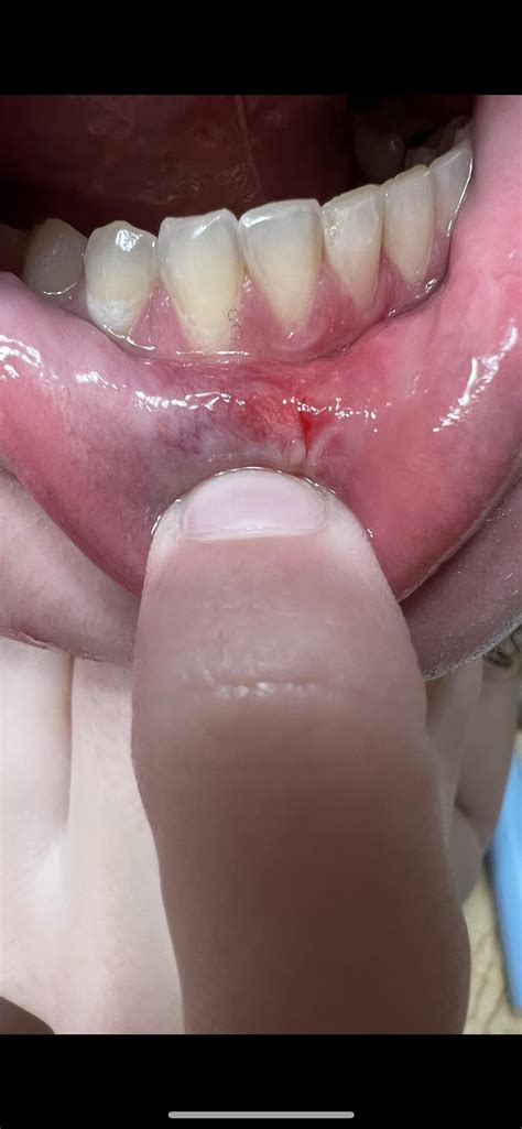 Lip Biopsy Complications Rsjogrens