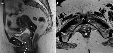 Imaging The Female Urethra Us And Mri In Cystic And Solid Pathologic