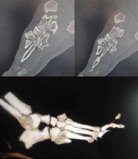Ct Scan Images Demonstrating The Non Displaced Lateral Cuneiform
