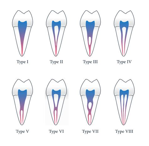 Representation Of Vertuccis Root Canal System Classification