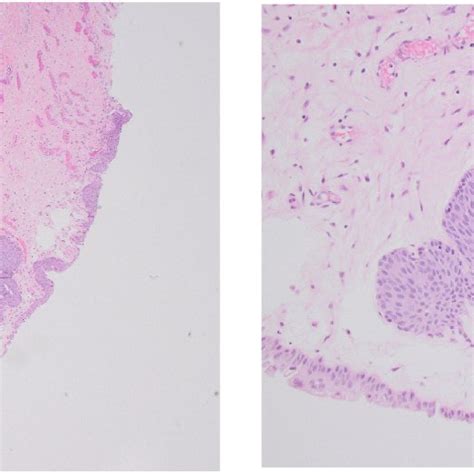 Ultrasound Imaging Of Urethral Polyp At Time Of Presentation Sagittal Download Scientific