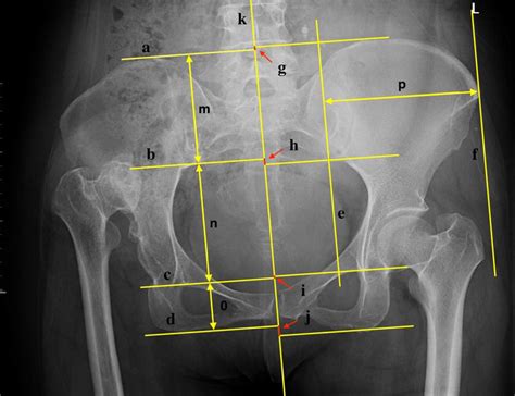 Measurement Parameters Determined On Ap Pelvic Radiographs M Height Download Scientific