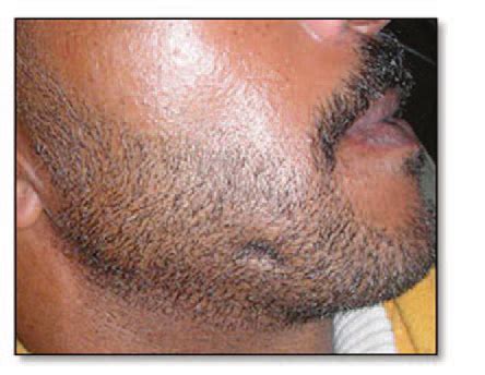 Dimple In The Skin Of The Right Cheek Download Scientific Diagram