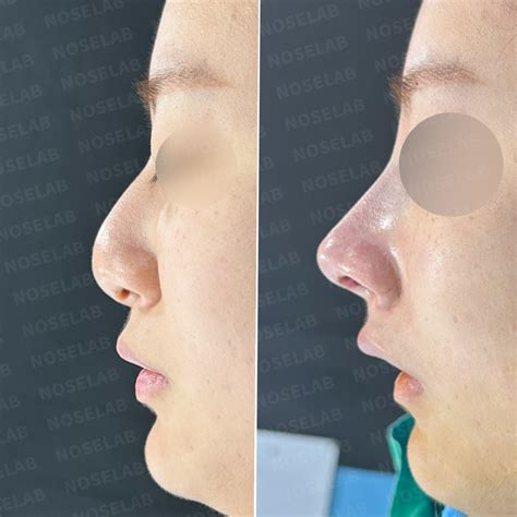 Bulbous Nose Correction Rhinoplasty With Rib Cartilage