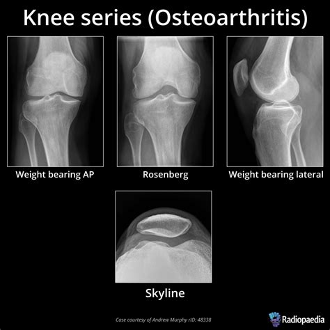 Osteoarthritis X Rays