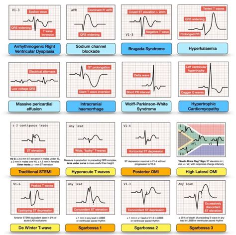 16 Important Ecg Patterns That Should Not Be Missed More Ecg Lecture
