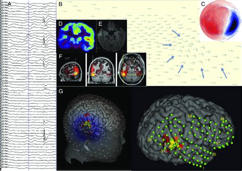 Case No 7 A Interictal Epileptic Discharges Recorded By Iceeg Are