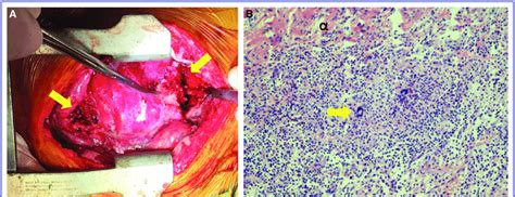 A Surgeons View Of The Multiple Small Thick Walled Fibrinous Download Scientific Diagram
