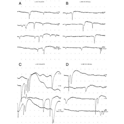 Pelvic Magnetic Resonance Image Mri Revealed Left S2 Nerve Root