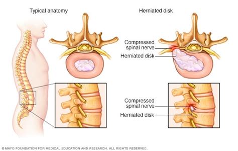Herniated Disk Mayo Clinic