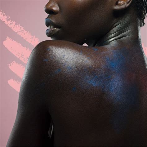 Psoriasis On Black Skin Being A Black Woman With Psoriasis Is Tough