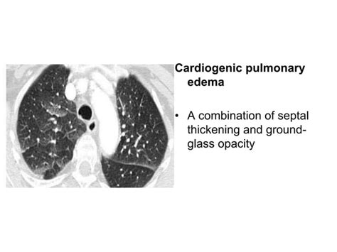 Hrct Lung Basic Interpretation Ppt Lung And Respiratory Health Diseases And Conditions