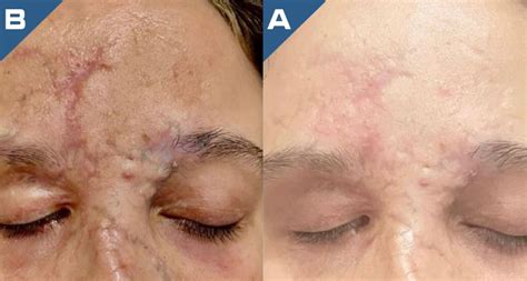 Pico Legend Pico Legend Laser System