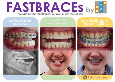 Wdc แก้ไขฟันสบเปิด แบบไม่ผ่าตัด คลินิกทันตกรรมสีขาว Facebook