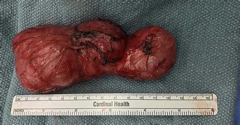 1 6 Lb Mesenteric Duplication Cyst Album On Imgur