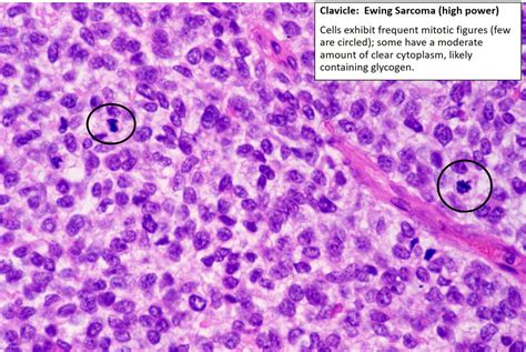 Clavicle Ewings Sarcoma Nus Pathweb Nus Pathweb