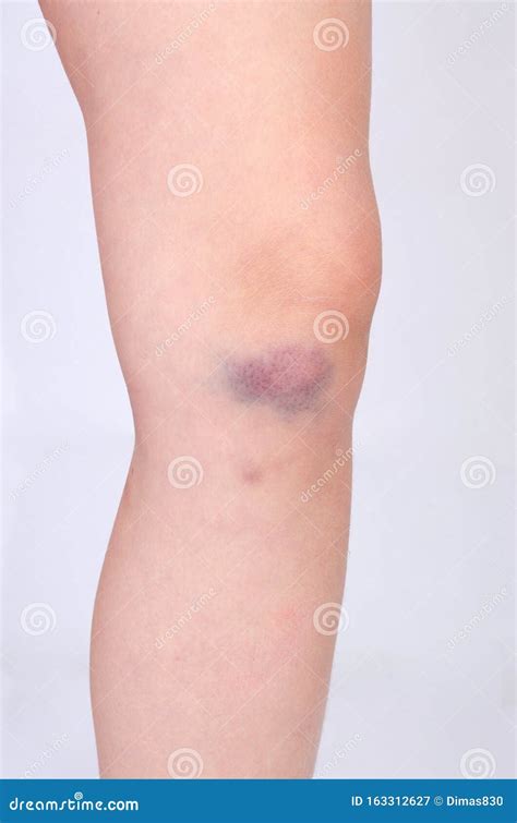 Massage Bruised Knee At Maddison Loch Blog