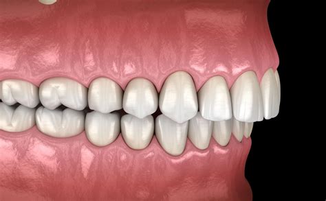 What Is An Overbite And How Is It Corrected