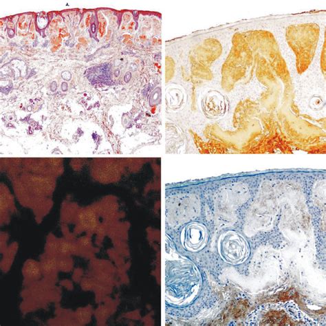 Cutaneous Involvement By Systemic Amyloidosis With Deposits Of Kappa