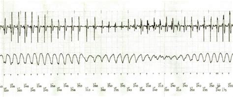 Portion Of The Electrogram From Interrogation Of The Patients Icd On