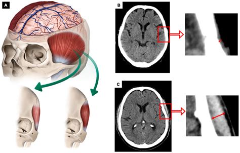 Contusion Cerebral Anisocoria Without Extraocular Muscle Impairment