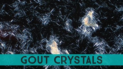Gout Crystals