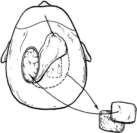 11 自体颅骨外板移植修复颅骨缺损 整形外科手术