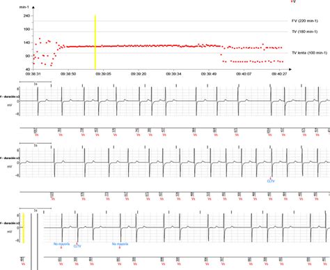 Interesting Episode Demonstrating The Transition From Atrial