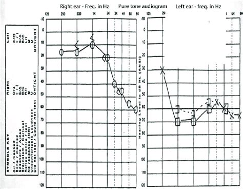 Baseline Audiogram When The Patient Was Referred To Otology Clinic Cnt Download Scientific