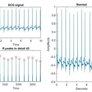 Three Real Examples Of False‐positive Ecg Findings Generated By V1 And