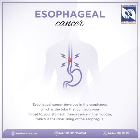 Esophageal Cancer Diagram