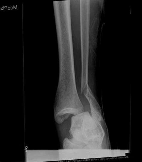 Science Research 2022 Bone Fracture Detection Object Detection Dataset