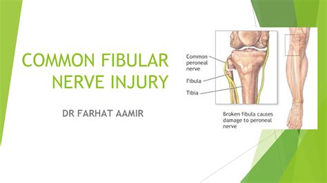 Solution Lecture On Common Fibular Nerve Injury Studypool