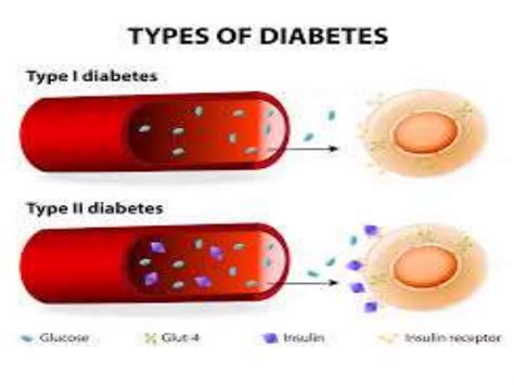 Diabetes Ppt