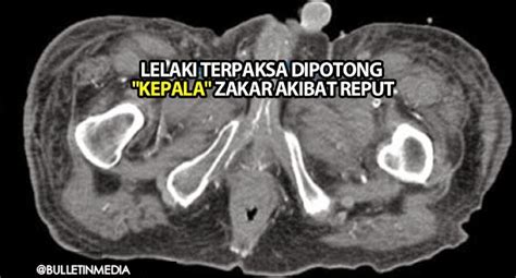 Lelaki Warga Emas Terpaksa Dipotong `Kepala’ Zakar Akibat Reput