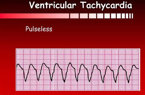 Pulseless Ventricular Tachycardia Symptoms Causes And Treatment