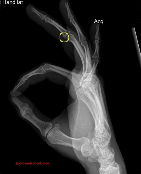 Case 6 In A Jam Sport Med School
