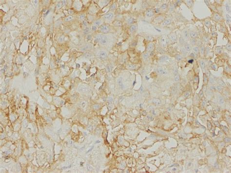 Immunostaining Of 60 Of Tumor Cells With Moderate Expression Intensity
