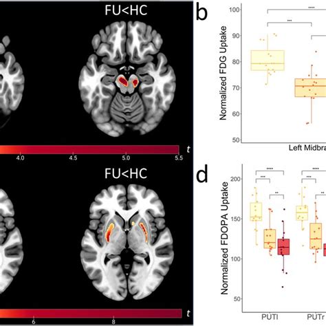 Between Group Differences In Fdg And Fdopa Uptake Versus Healthy Download Scientific Diagram