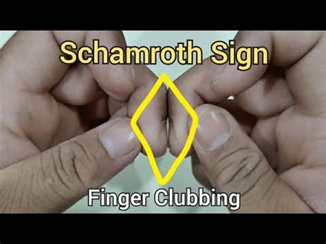 Schamroth Sign For The Examination Of Finger Clubbing Youtube