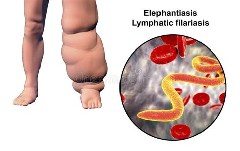 Leg Of A Person With Elephantiasis Lymphatic Filariasis Stock