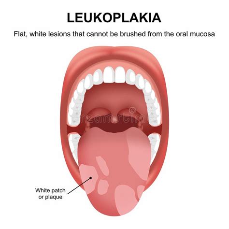 Leukoplakia Illustration Stock Image Illustration Of Text 391855131