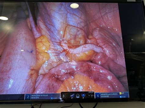 Bowel Endometriosis Symptoms Diagnosis And Treatment Options