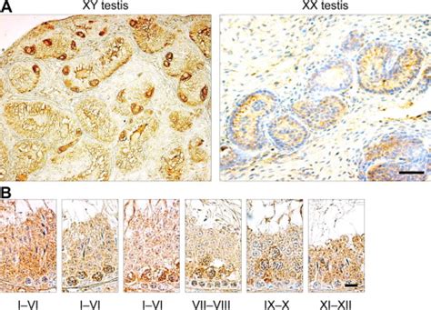 Gene Expression Profile During Testicular Development In Patients With