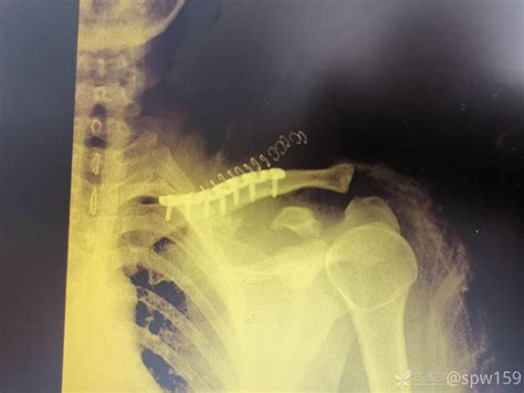 那些骨科常见的坑，你踩过吗？如何避坑？ 德医医学 助力医学教育发展！